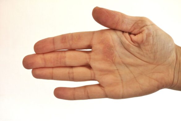 4 Natural Remedies for Palm Psoriasis with Herbs & Recipes