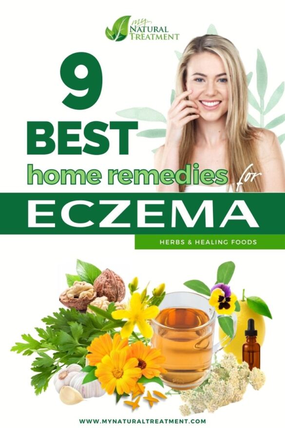 9 Best Home Remedies for Eczema - Heal Eczema at Home